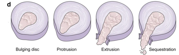 【질병탐구】⑤추간판탈출증